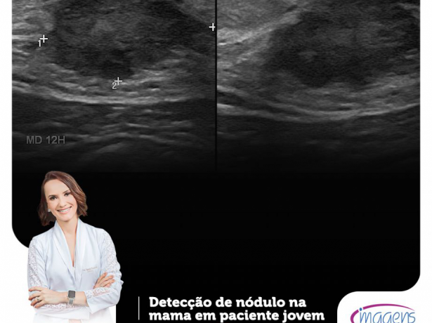 Detecção de Nódulo em uma Paciente Jovem | Dica do Especialista ...