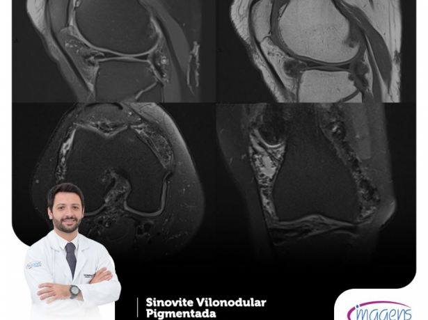 Sinovite Vilonodular Pigmentada | Dica do Especialista - Imagens ...