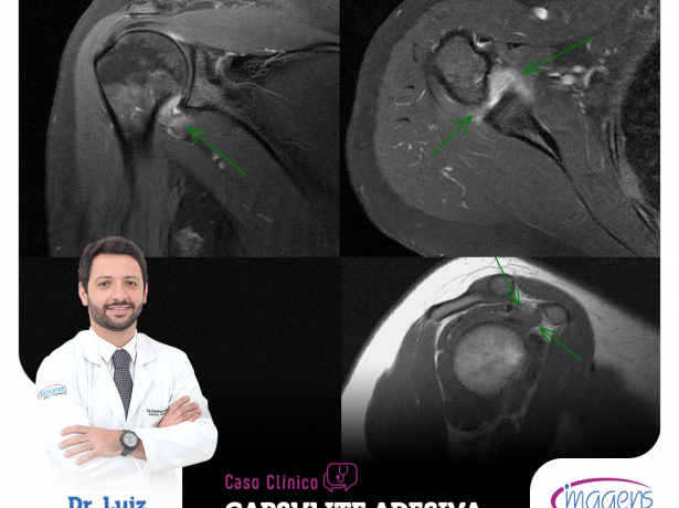 Capsulite Adesiva ou "ombro congelado" | Dica do Especialista - Imagens ...